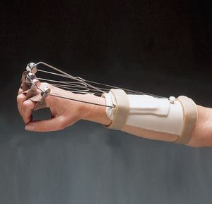 Radial Nerve splints | Radial Wrist Splints | Hand Splinting