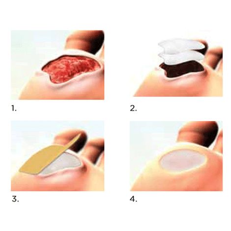 Covalon ColActive Plus Collagen Matrix Dressing