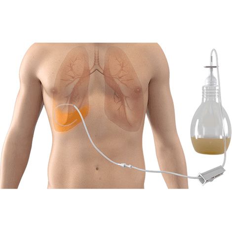 Buy Pleural Catheter System I Pleurx Drainage Kit